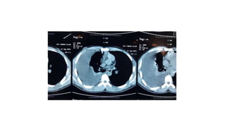 open vs VATS decortication | PPTX | Physical Therapy | Wellness