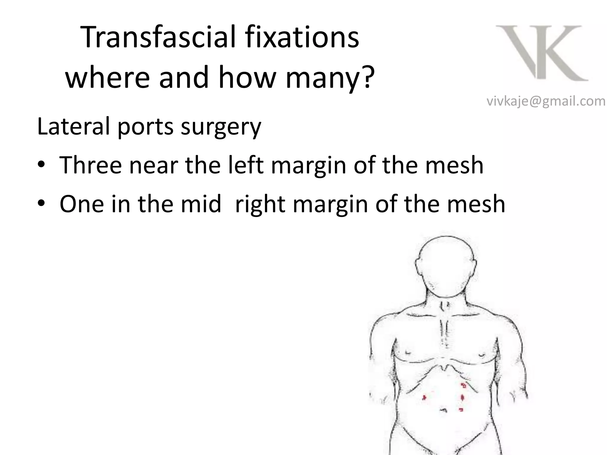 Suprapubic hernia - Unique Features | PPTX
