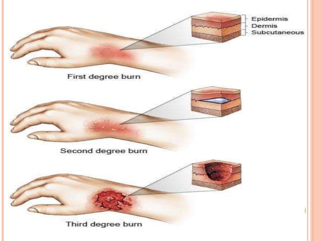 Burns & cosmetic surgery | PPTX | First Aid | Injuries