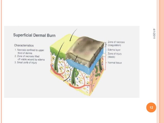 Burns & cosmetic surgery | PPTX | First Aid | Injuries