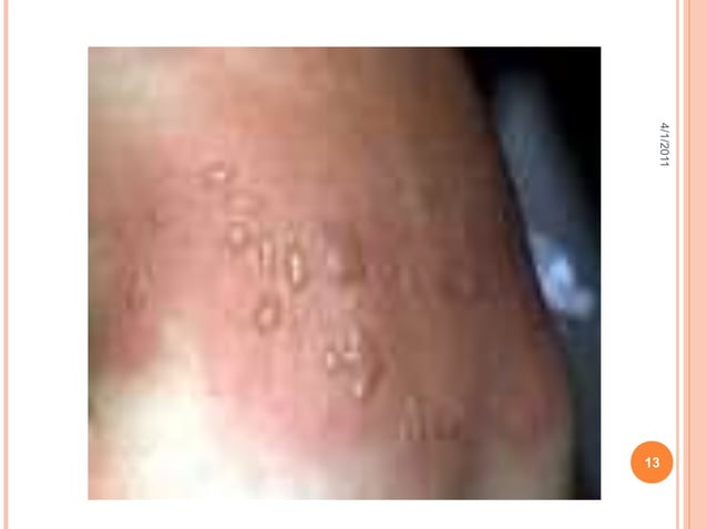 Burns & cosmetic surgery | PPTX | First Aid | Injuries