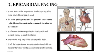 unit#04-7 Cardiac pacing.pptx monitor hearts rate | PPTX