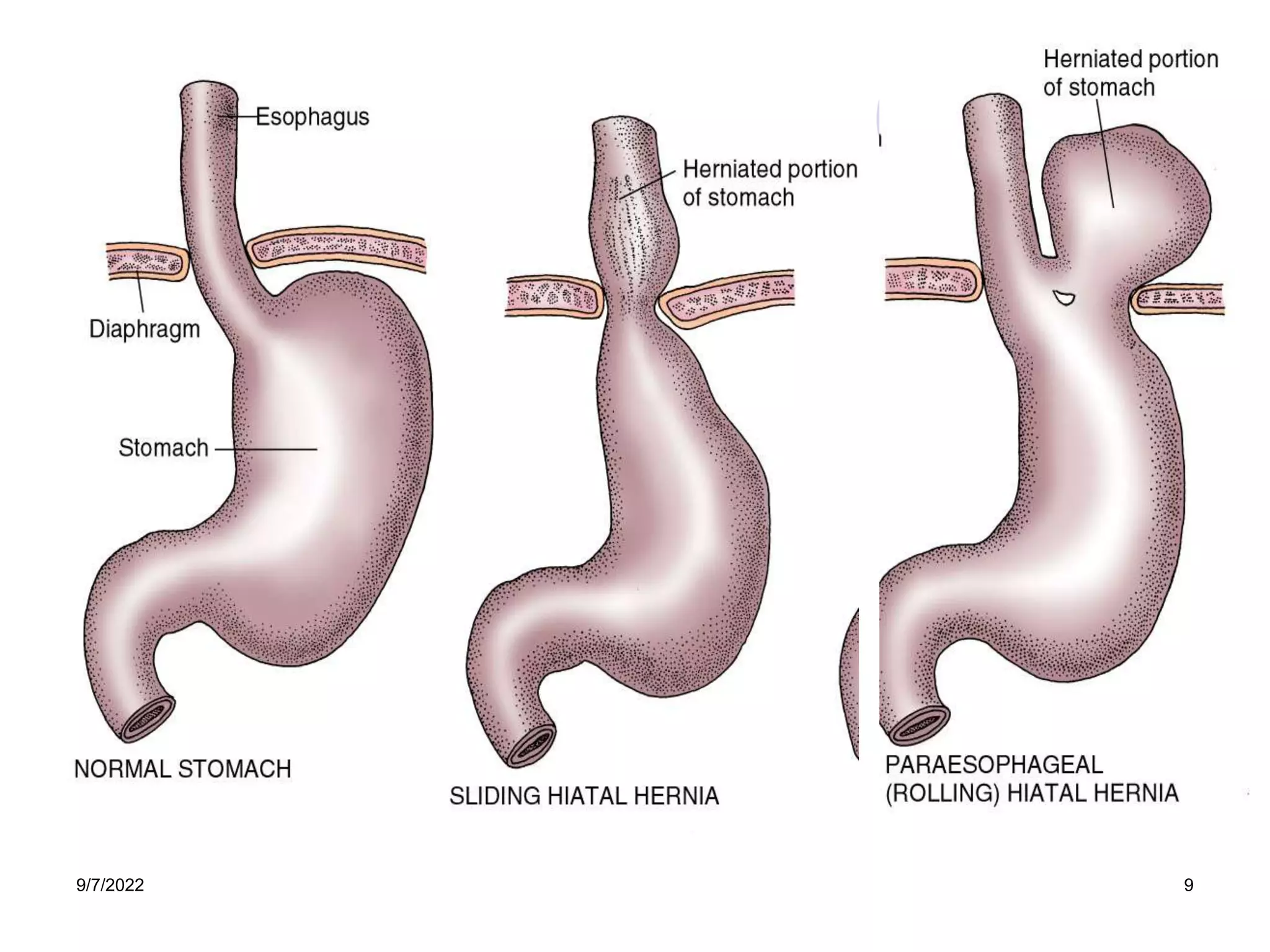 Unit 1_ 2 Hiatal hernia, Achalasia, Esophageal cancer, Gastritis, Ulcer disease, gastric ...