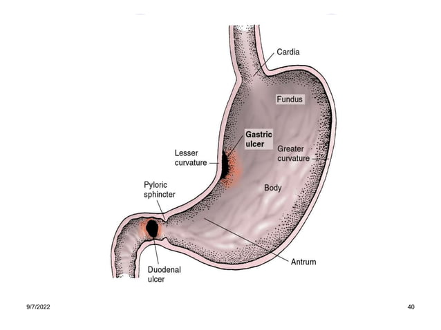 Unit 1_ 2 Hiatal hernia, Achalasia, Esophageal cancer, Gastritis, Ulcer ...