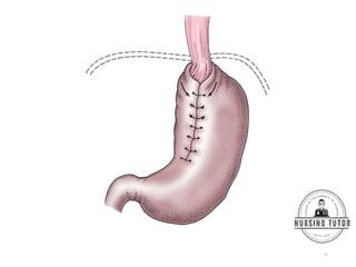 Unit 1; Gastro-Intestinal Disorders By Nursing Tutor-2.pptx