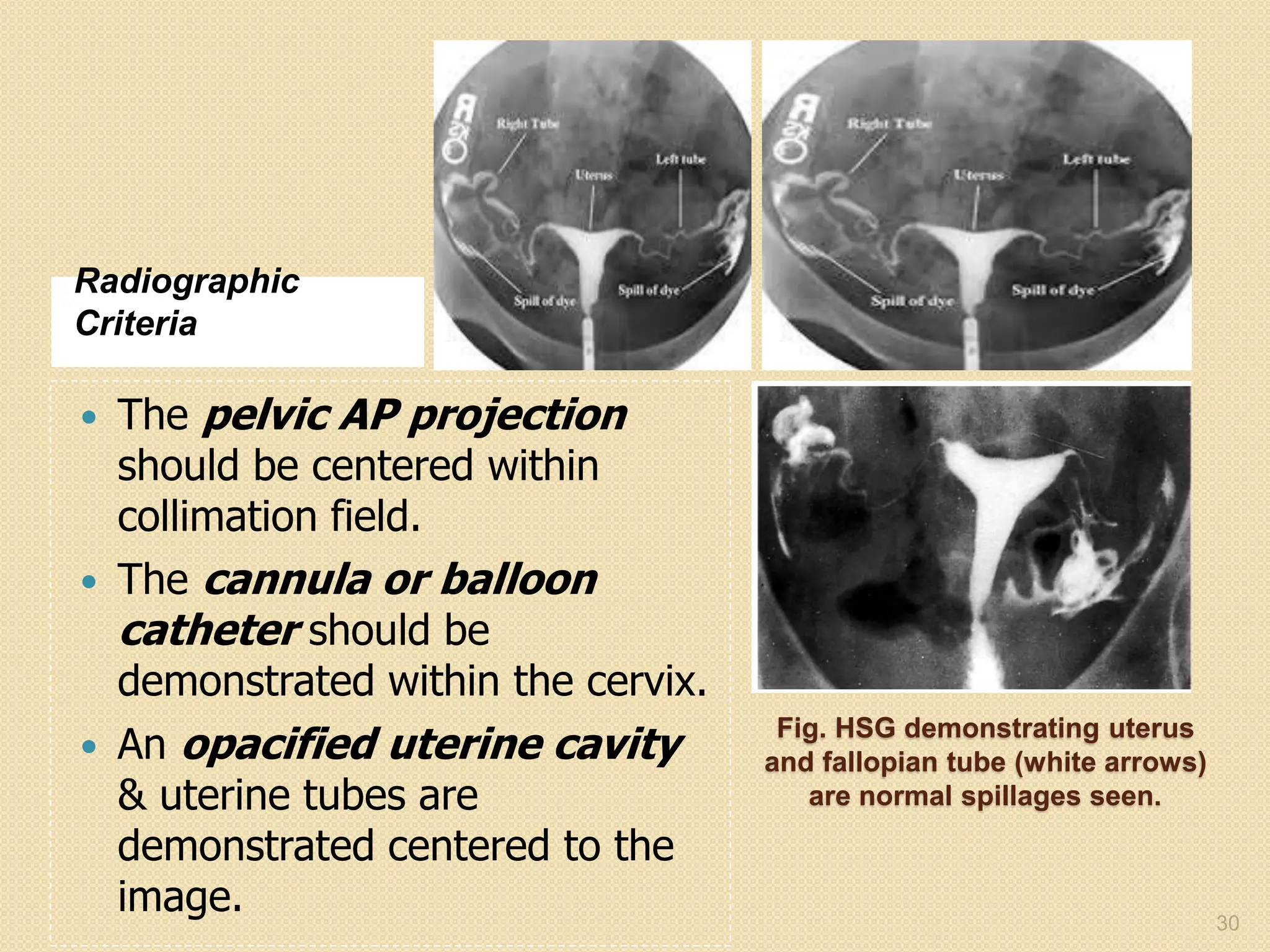 Special radiographic procedure -Hysterosalpingography.pptx