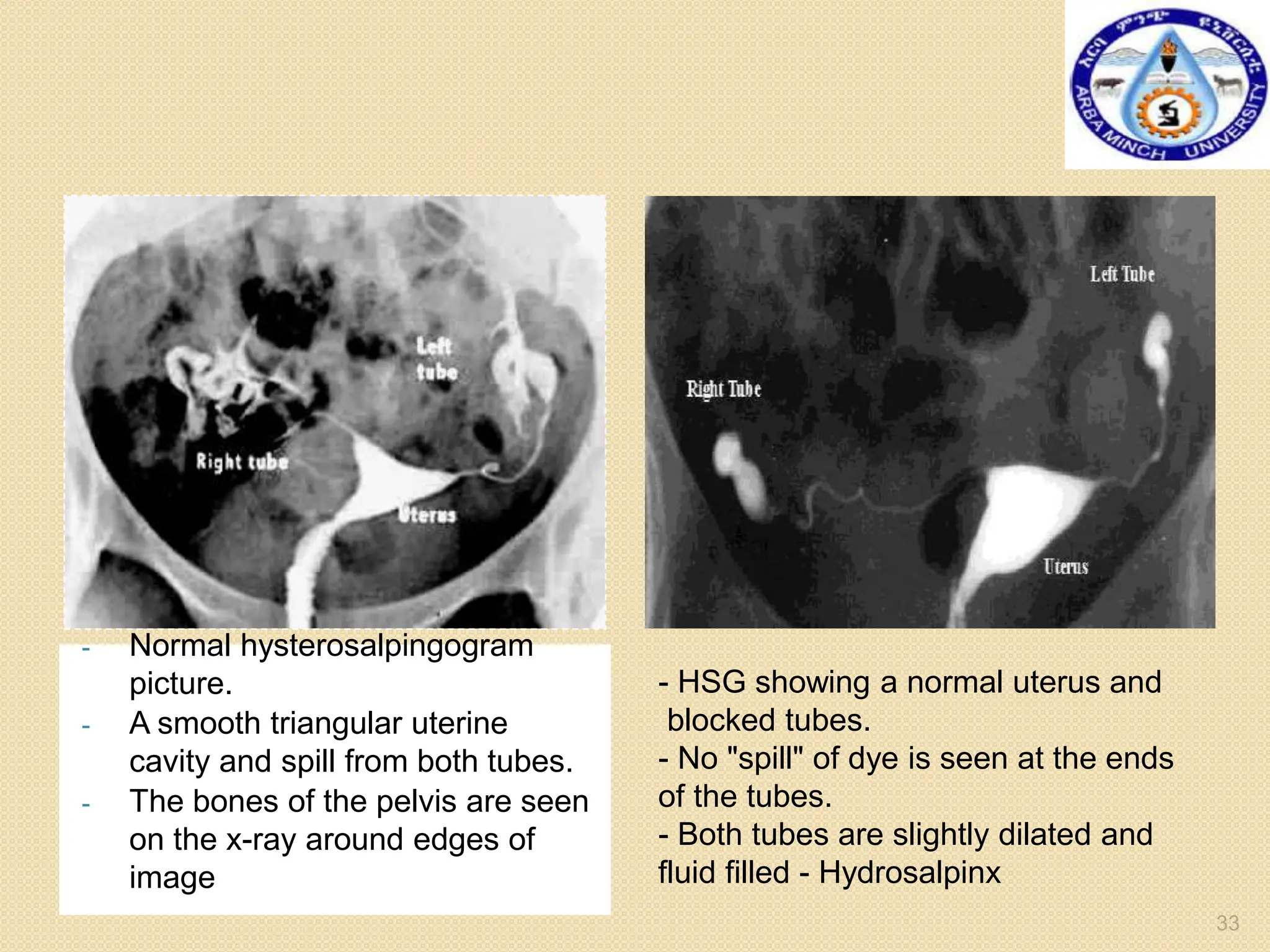 Special radiographic procedure -Hysterosalpingography.pptx