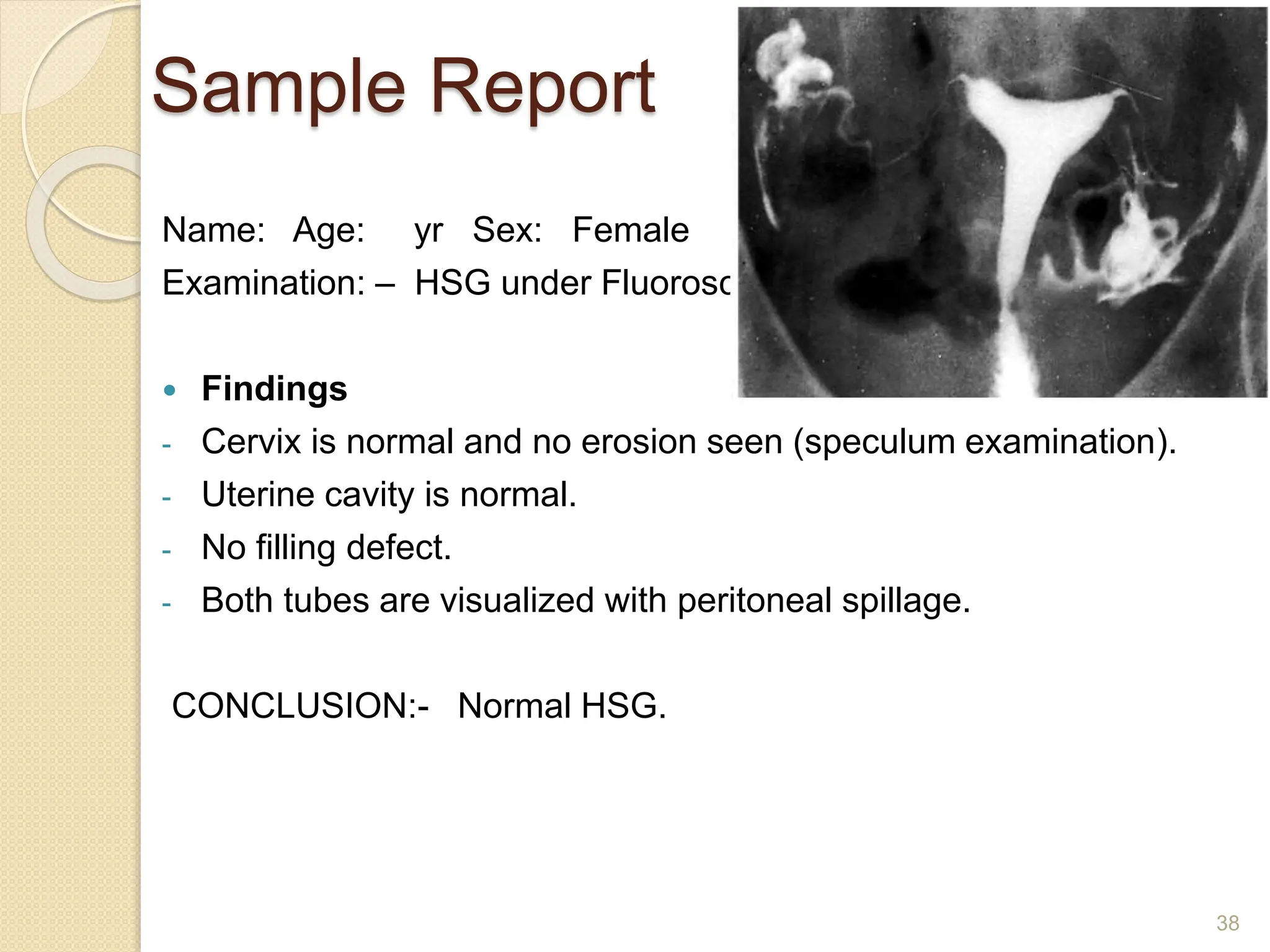 Special radiographic procedure -Hysterosalpingography.pptx