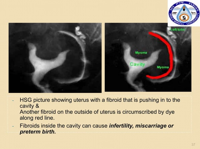 Special radiographic procedure -Hysterosalpingography.pptx | Pregnancy ...