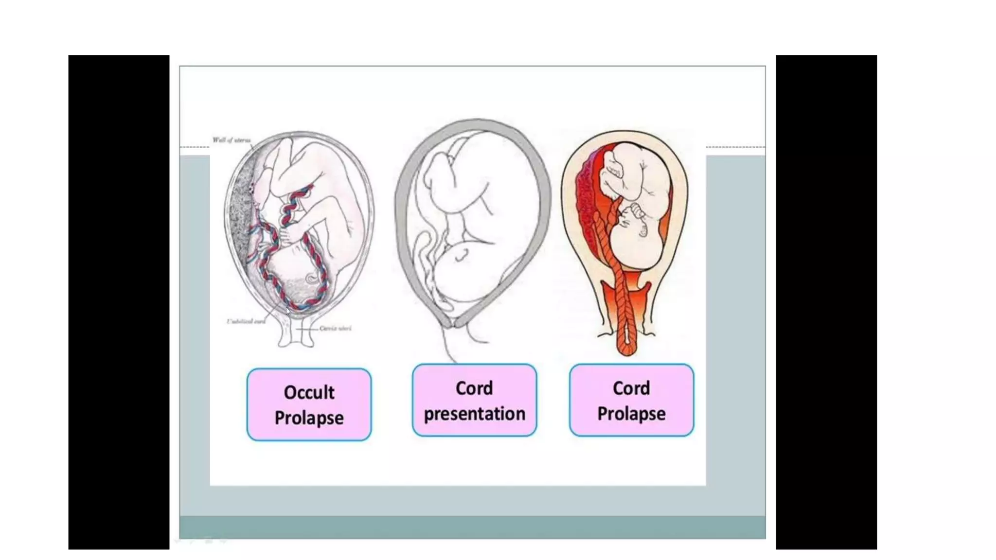 UNIT 3 FETAL DISTRESS MATERNAL,FETAL MONITORING UMBILICAL CORD ...