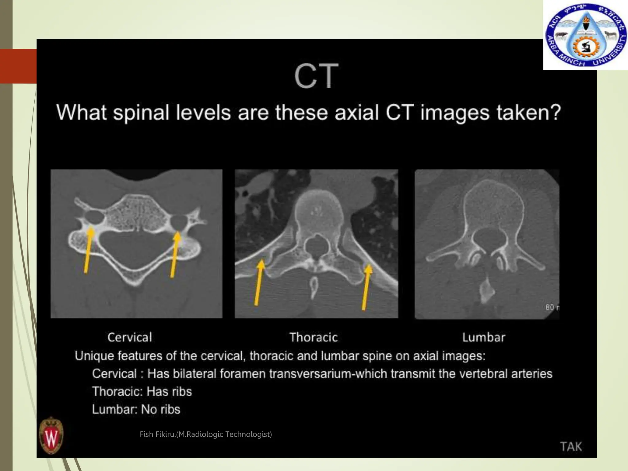 Special Radiographic procedure of spinal cord | PPTX
