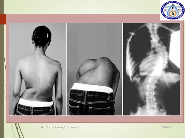 Special Radiographic procedure of spinal cord | PPTX