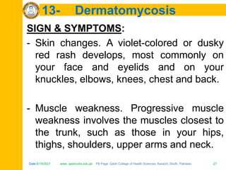 ascariasis, taeniasis,dermatomycosis | PPT