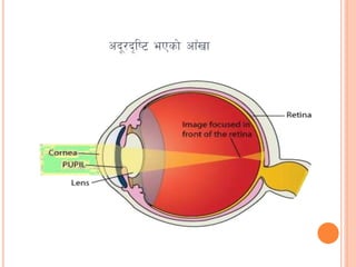 Science Unit 5 Defect of vision Nepali. | PPT