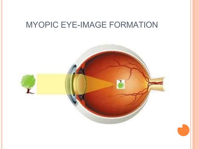 Science Unit 5 Defect of vision Nepali. | PPT