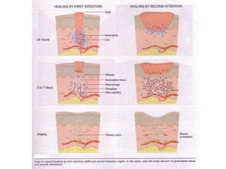 unit 5 Tissue Healing and Repair notes.ppt