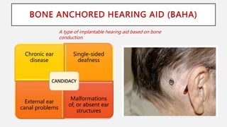 IMPLANTABLE HEARING DEVICES MASLP | PPTX