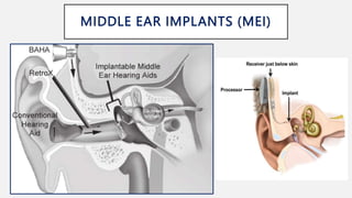 IMPLANTABLE HEARING DEVICES MASLP | PPTX