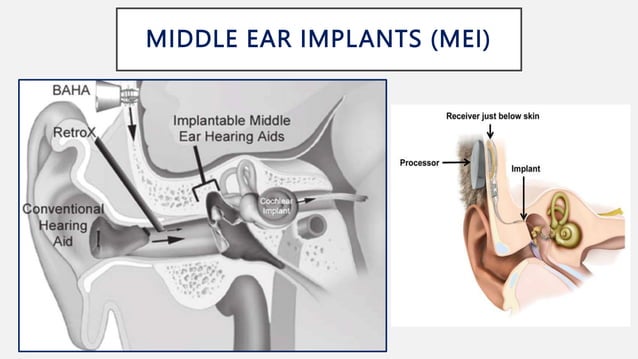 IMPLANTABLE HEARING DEVICES MASLP | PPTX