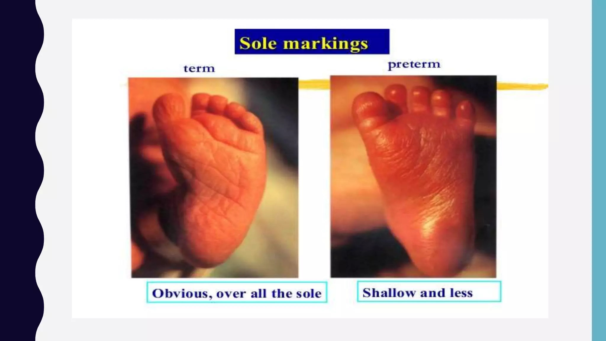 Normal Neonates | PPTX