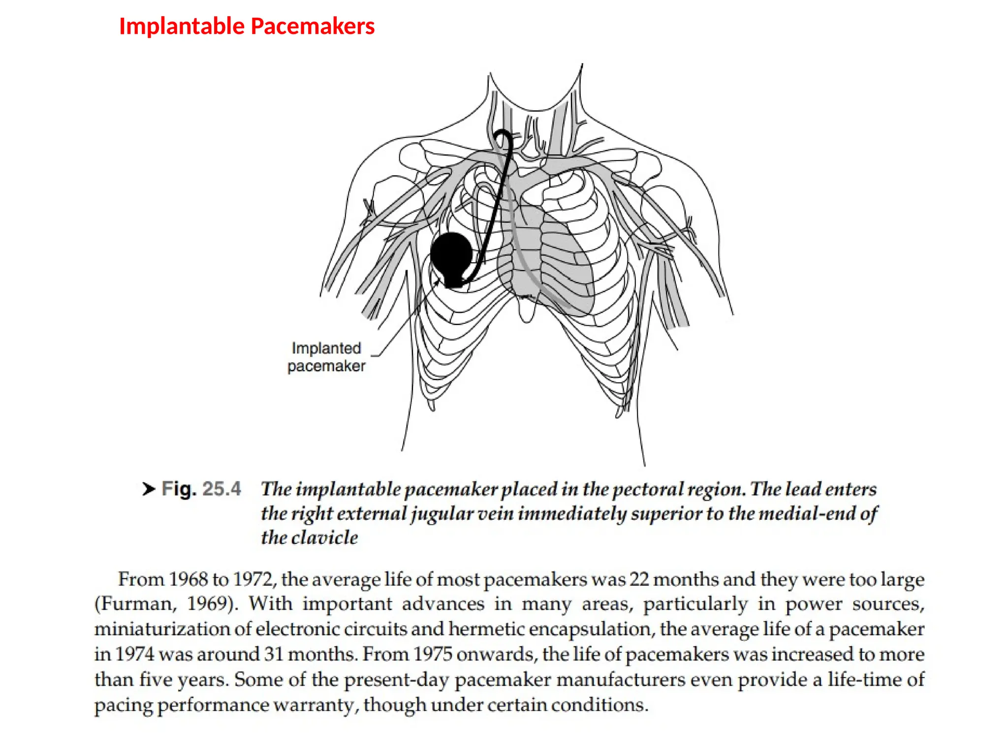 Unit 6 Pacemaker Ppt All Pace Maker Introduction In The Ppt Pptx