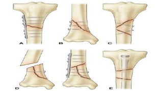 Unit I Medical and surgical Bone Fracture.pdf