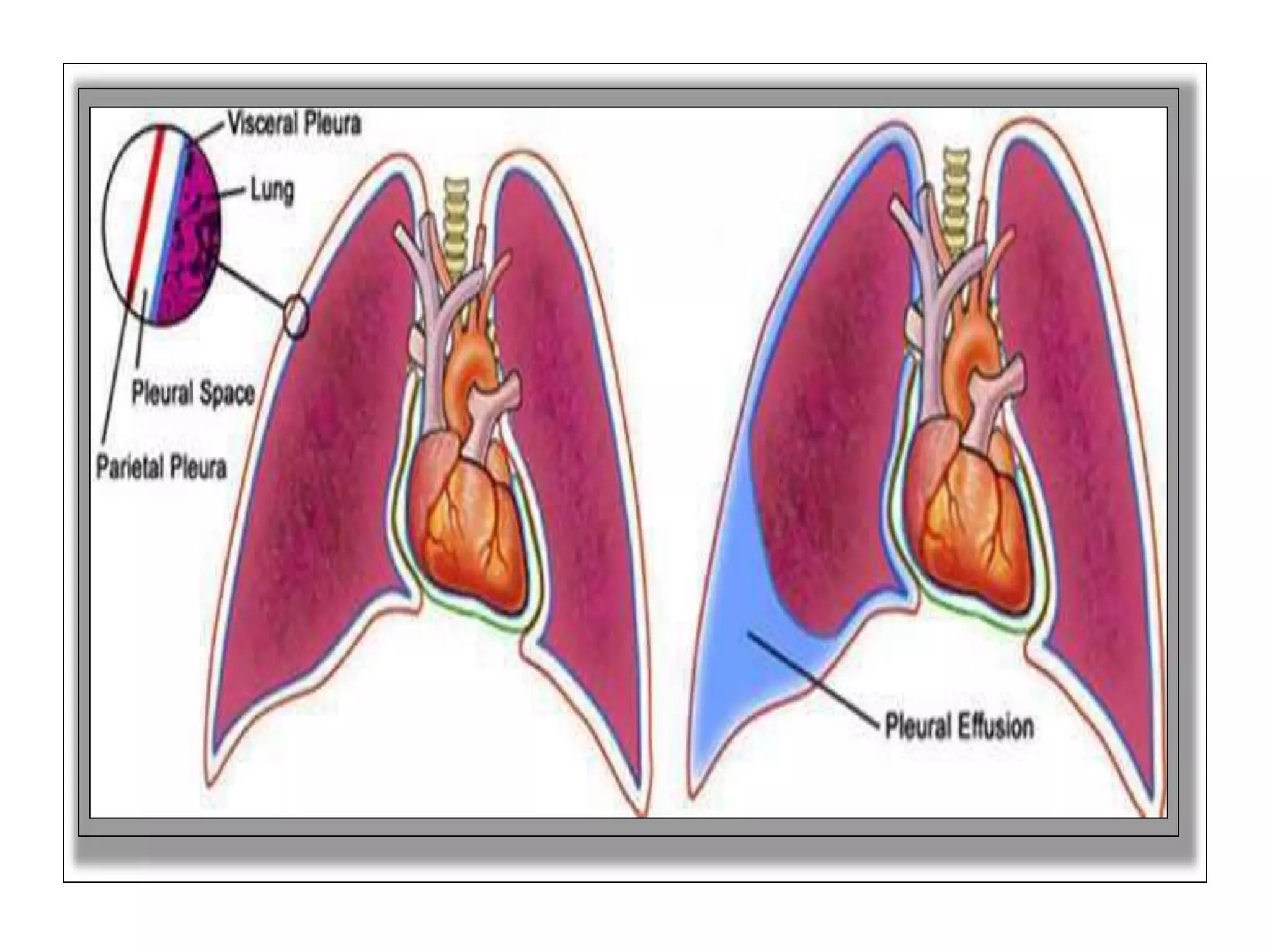 Unit III 3. Pleural Effusion.ppt