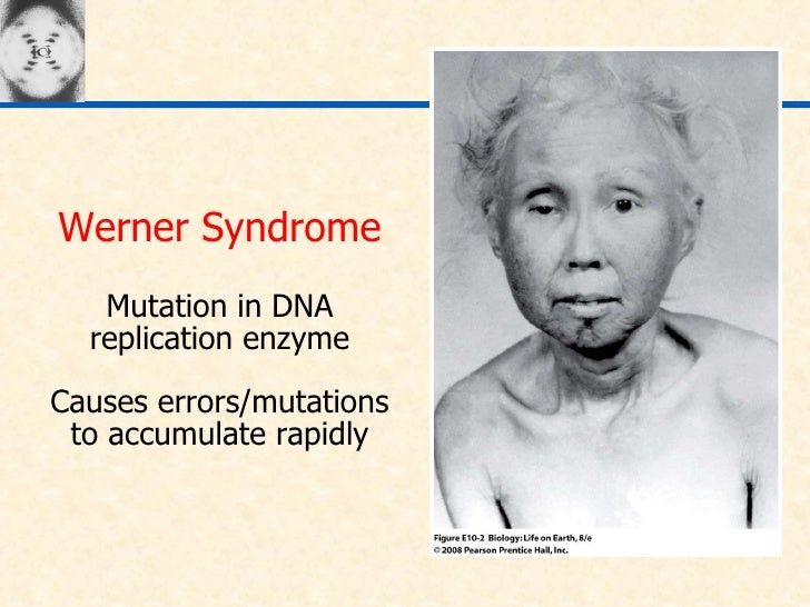 Werner39s Syndrome