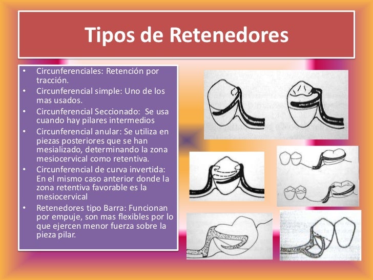 PROTESIS PARCIAL REMOVIBLE