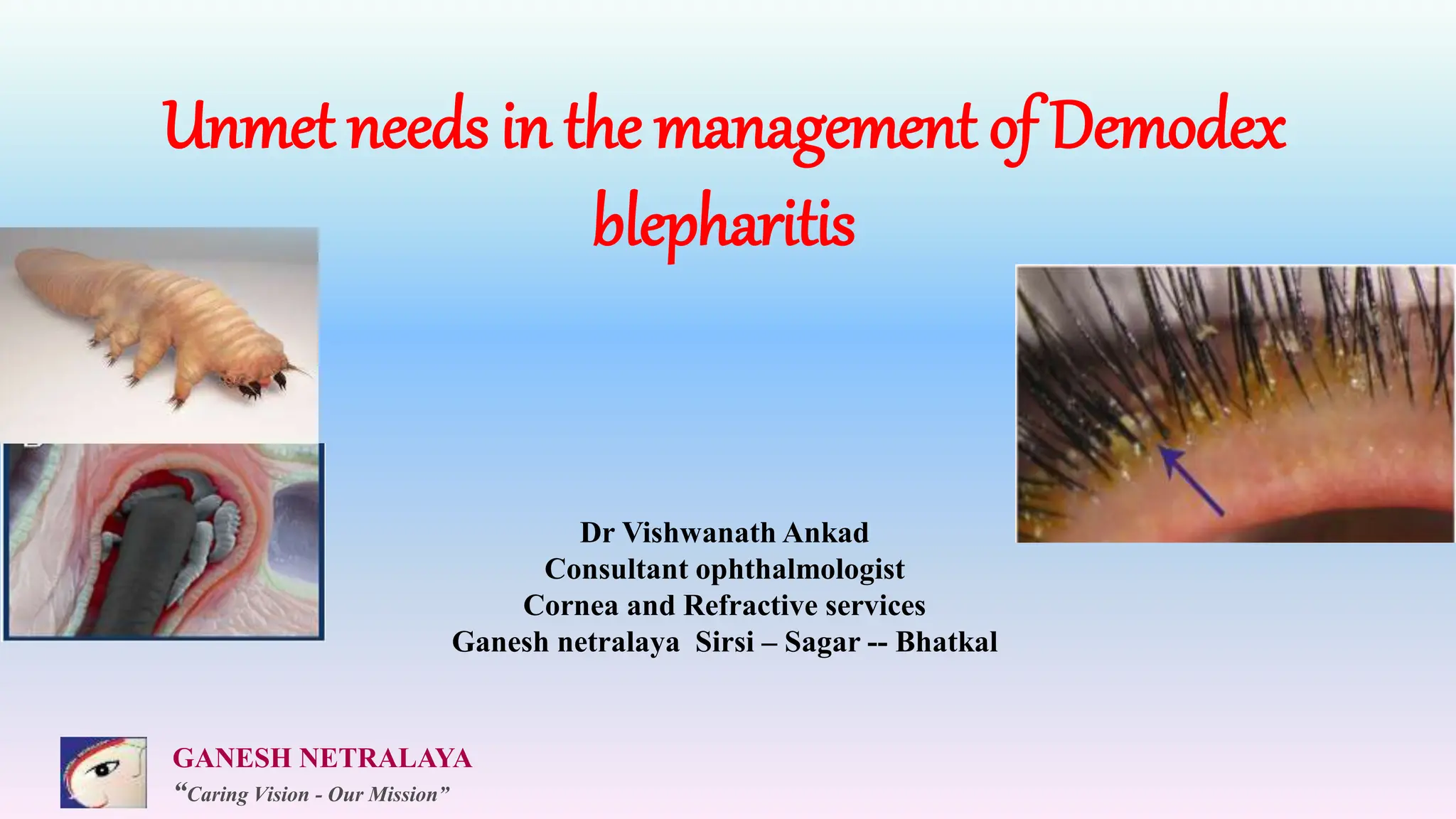 UNMET NEEDS IN THE MANAGEMENT OF DEMODEX BLEPHARITIS.pptx