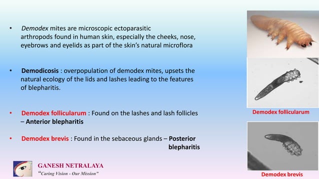 UNMET NEEDS IN THE MANAGEMENT OF DEMODEX BLEPHARITIS.pptx