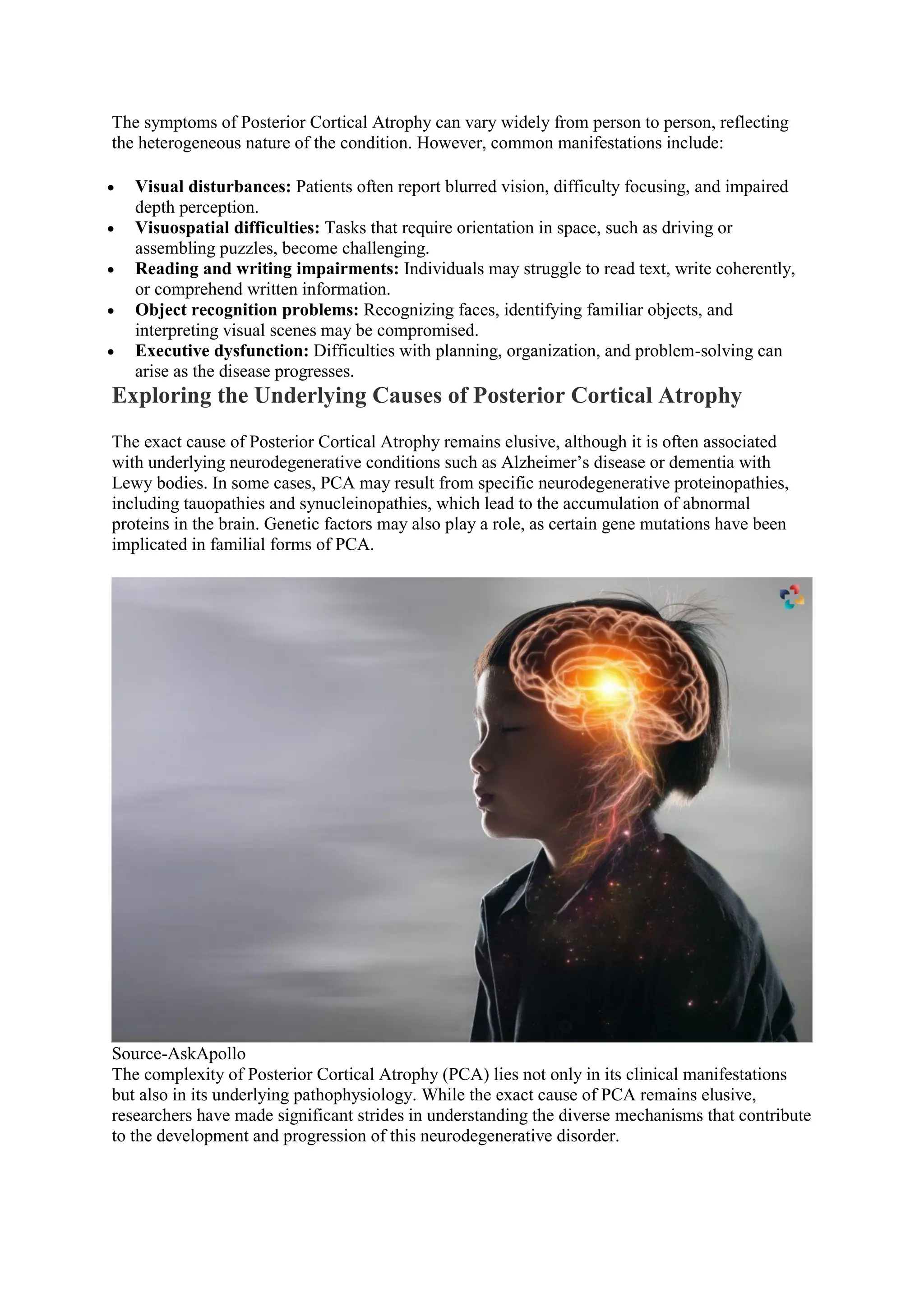 Mysteries of Posterior Cortical Atrophy: Symptoms, Causes, and ...