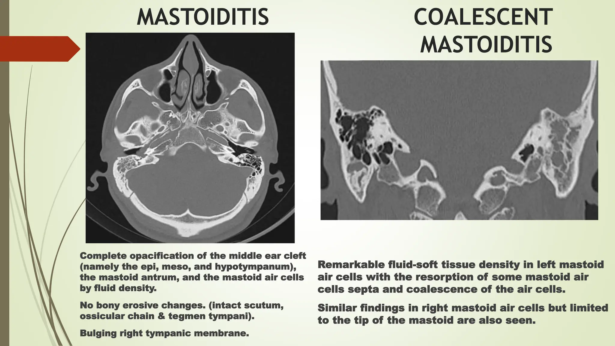Unsafe Chronic Otitis Media with Complications | PPTX