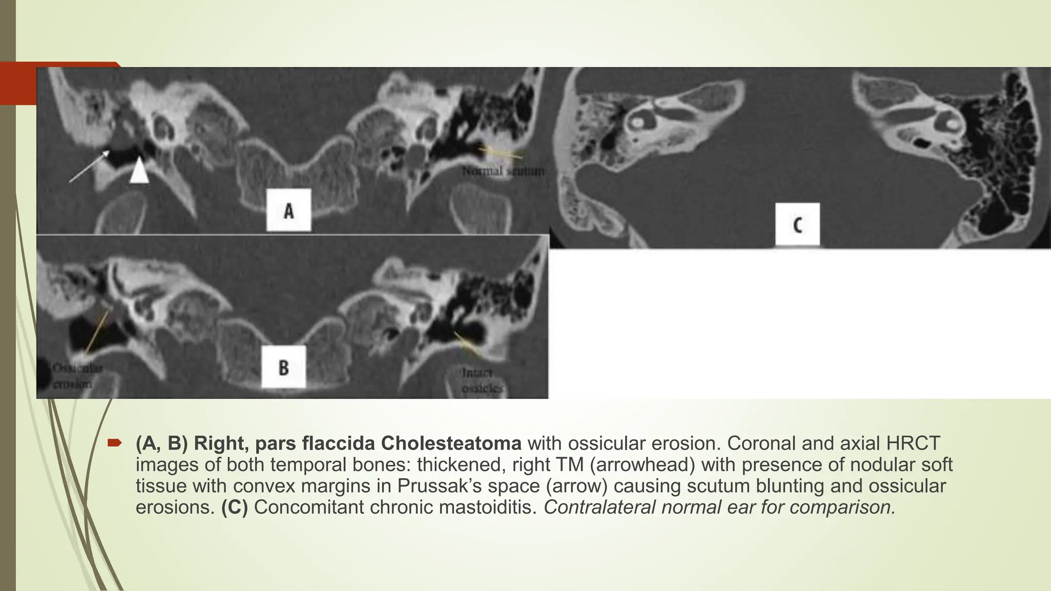 Unsafe Chronic Otitis Media with Complications | PPTX