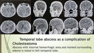 Unsafe Chronic Otitis Media with Complications | PPTX