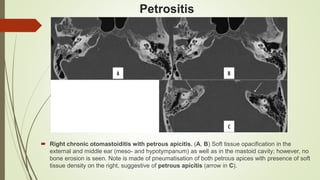 Unsafe Chronic Otitis Media with Complications | PPTX