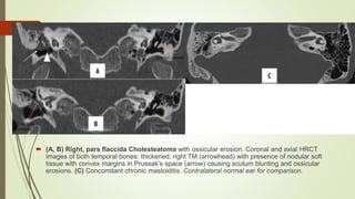 Unsafe Chronic Otitis Media with Complications | PPTX