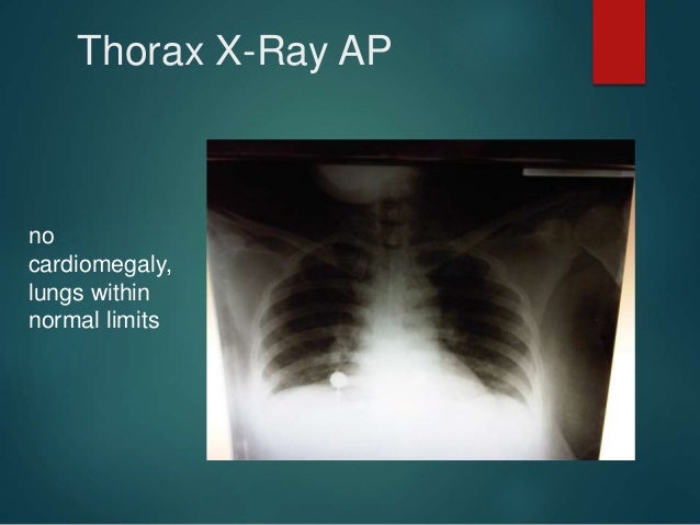 Unstable angina pectoris