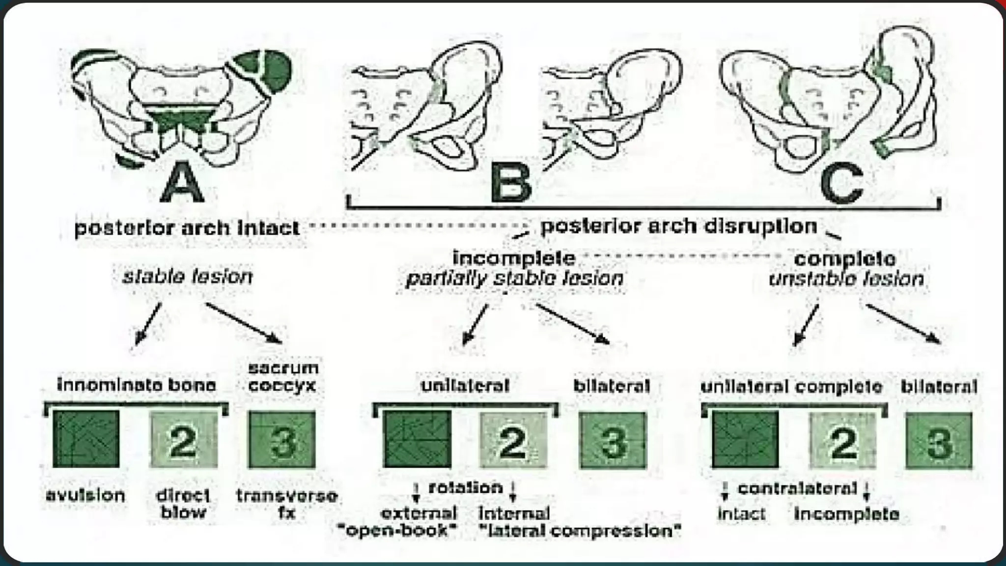Unstable Pelvic Fracture Presentation | PPTX
