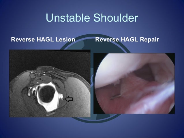 Arthroscopic Hagl Repair | Hagl Lesion Surgery – KUGLQU