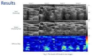 Unsupervised learning for acoustic shadowing artifact removal in ...