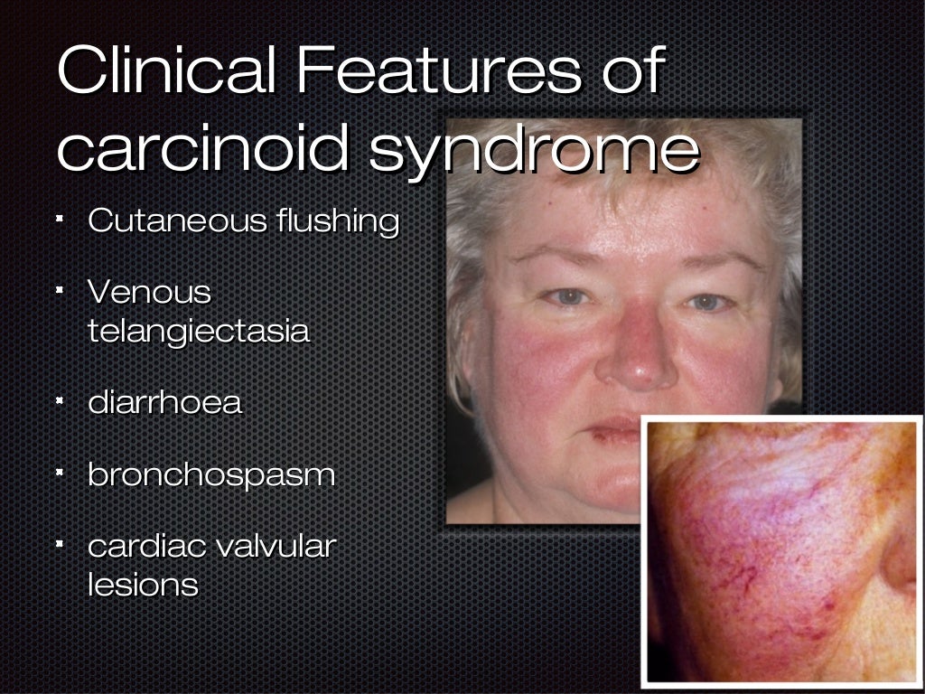 Carcinoid Tumour