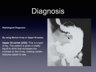 Upper Gi Series Ulcer