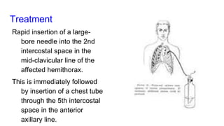 Thoracic Injury and Trauma | PPTX