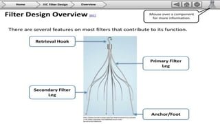 IVC Filter | PDF