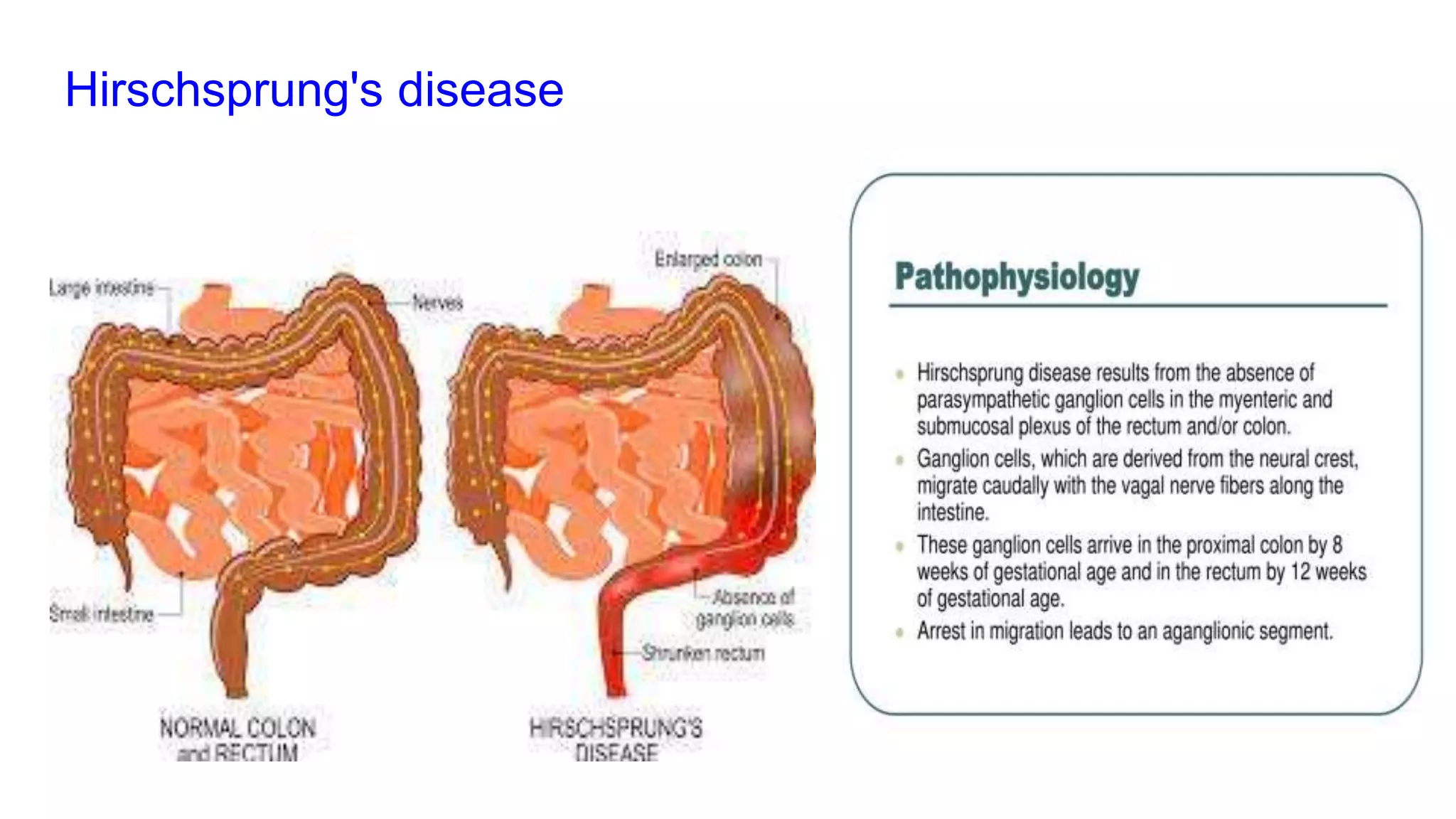 bilious vomiting in newborn.pptx