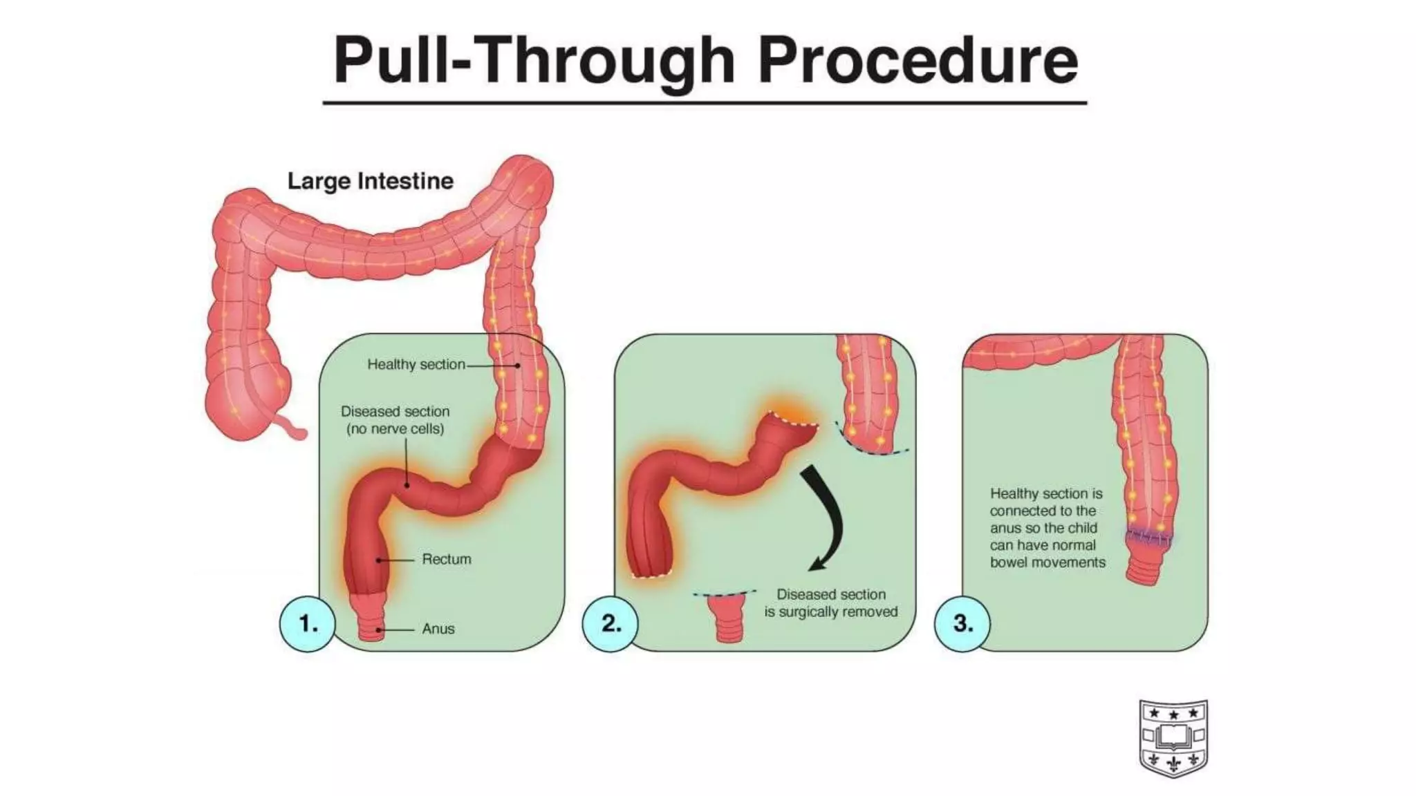bilious vomiting in newborn.pptx