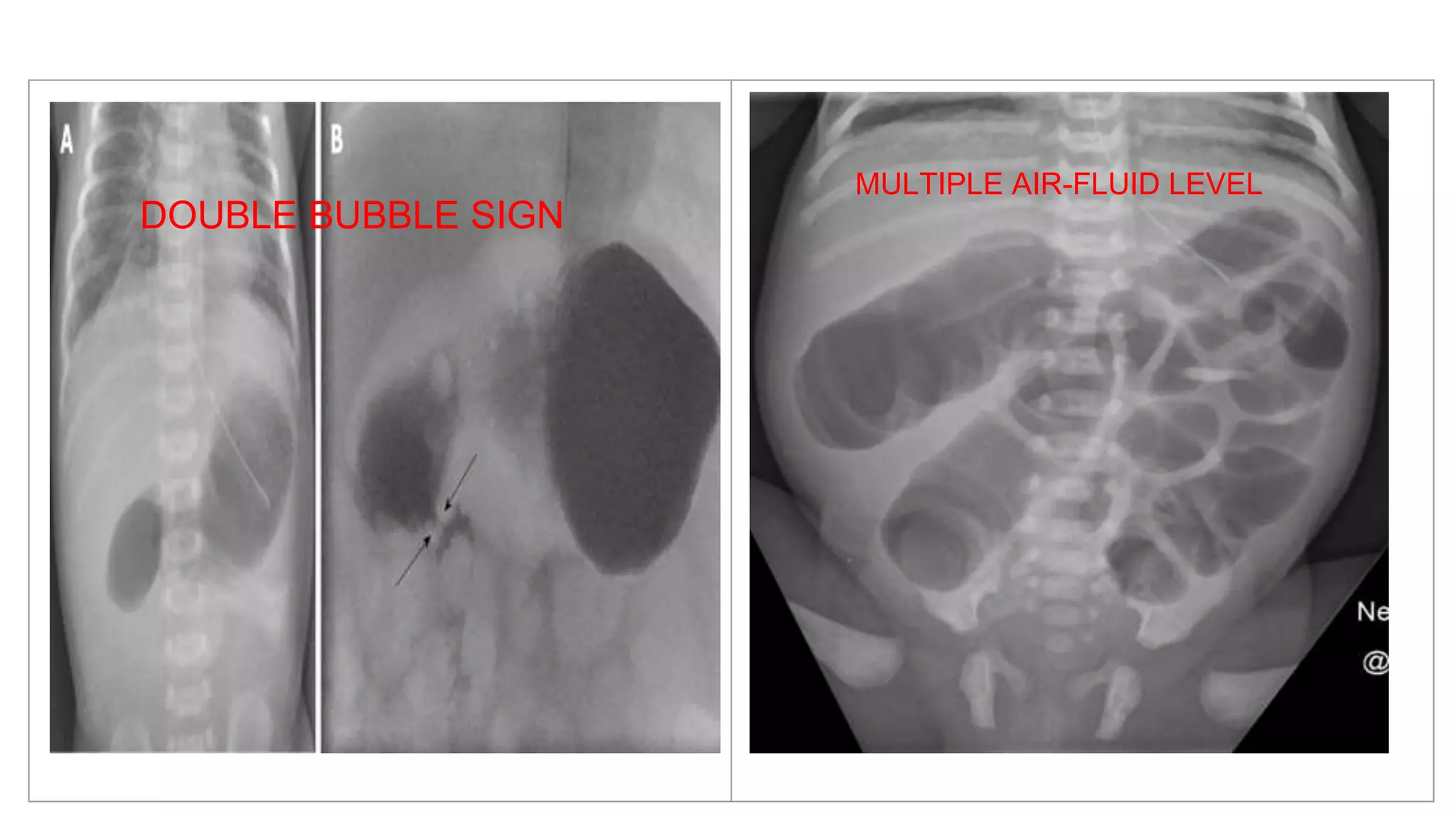 bilious vomiting in newborn.pptx