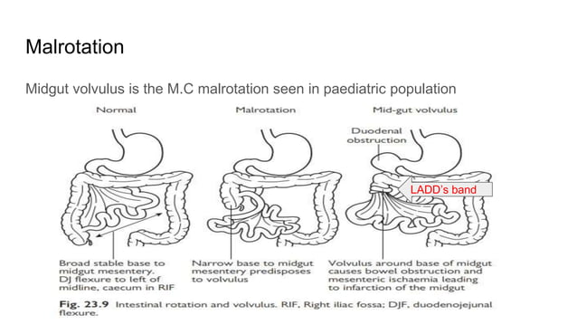 bilious vomiting in newborn.pptx | Digestive Disorders | Diseases and ...