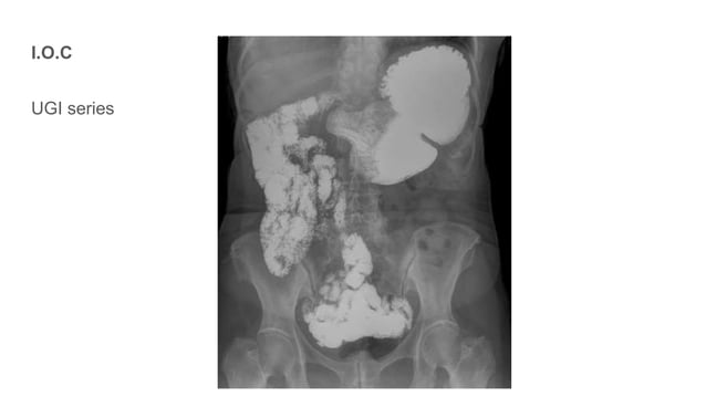 bilious vomiting in newborn.pptx | Digestive Disorders | Diseases and ...